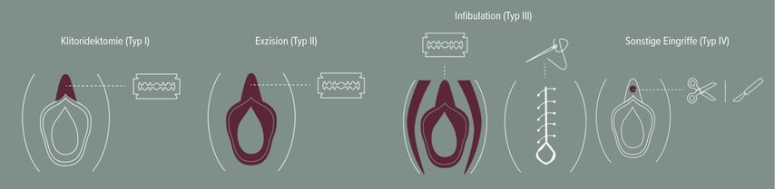 Weibliche Genitalverstümmelung - Gynäkologie & Geburtshilfe - Universimed - Knowledge that matters
